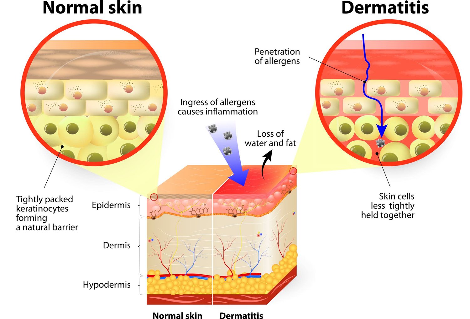 Fitc Or Dncb Contact Dermatitis Research